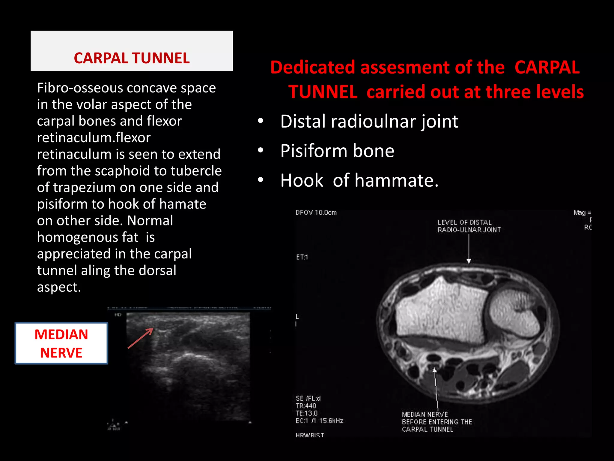 Carpal tunnel syndrome | PPTX