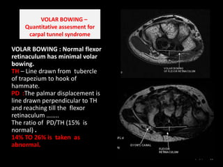 Carpal tunnel syndrome | PPTX