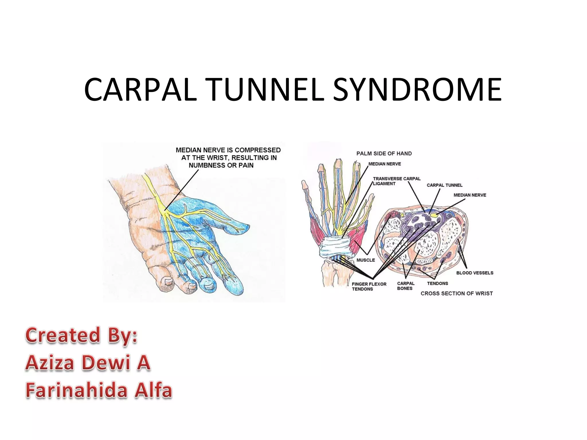 Carpal tunnel syndrome. | PPT