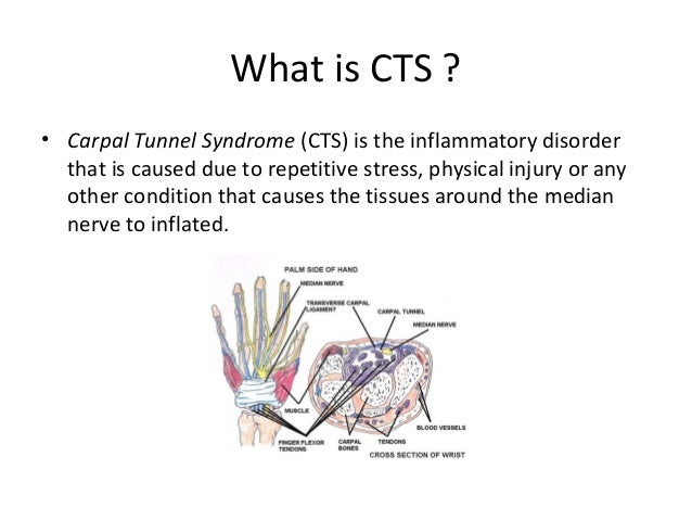 Carpal tunnel syndrome.