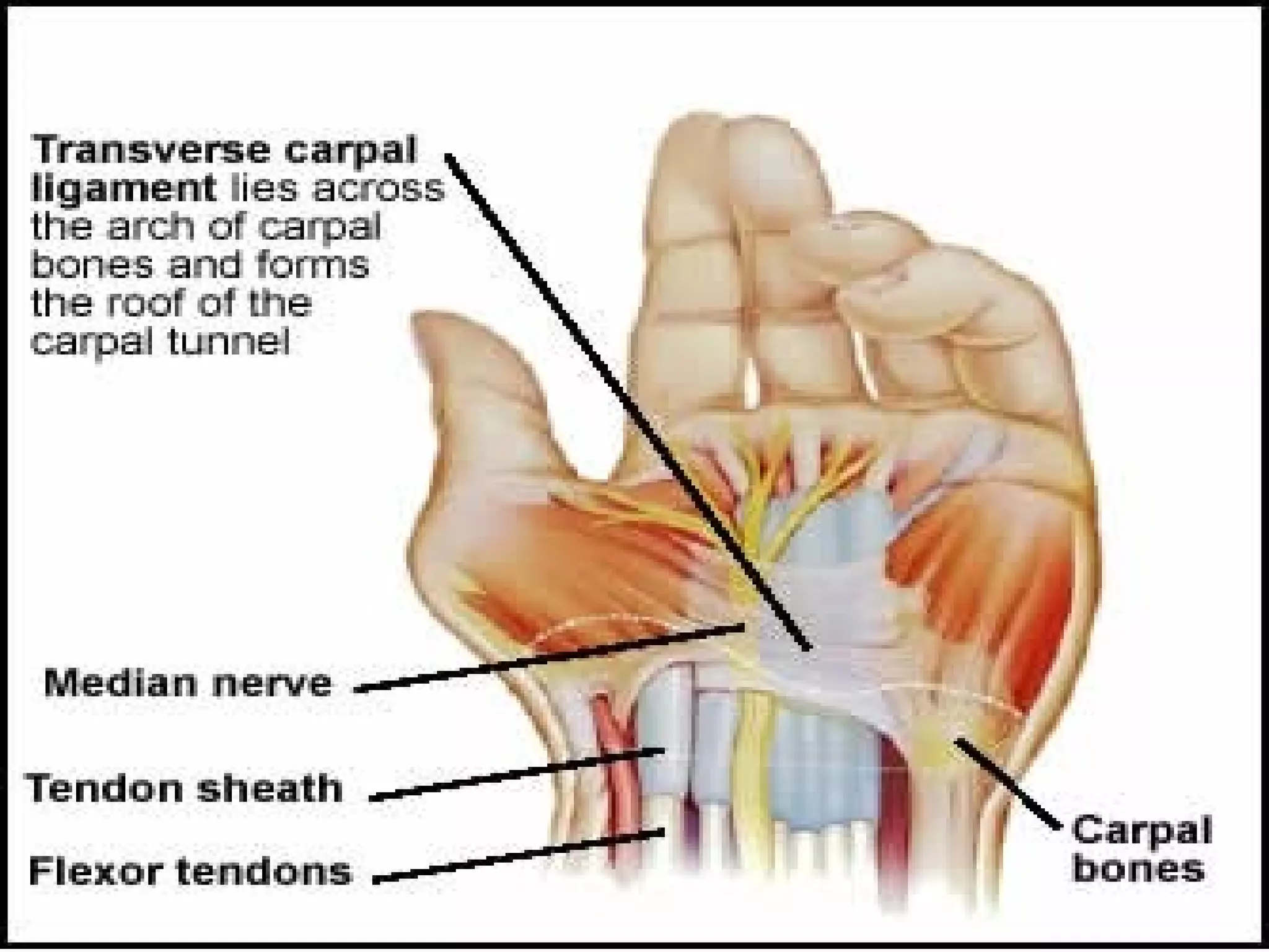 Carpal tunnel syndrome | PPT