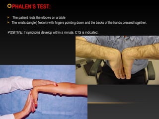 Carpal tunnel syndrome | PPT