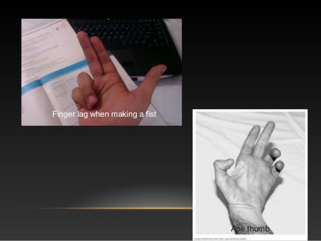 Carpal tunnel syndrome