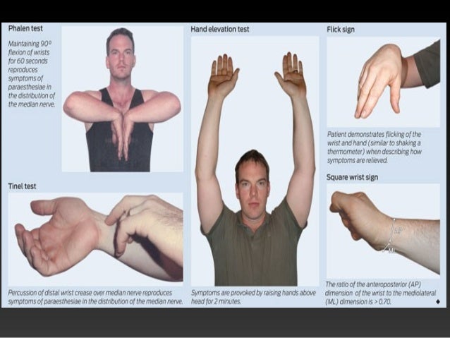 Carpal tunnel syndrome