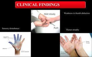 Carpal tunnel syndrome | PPT