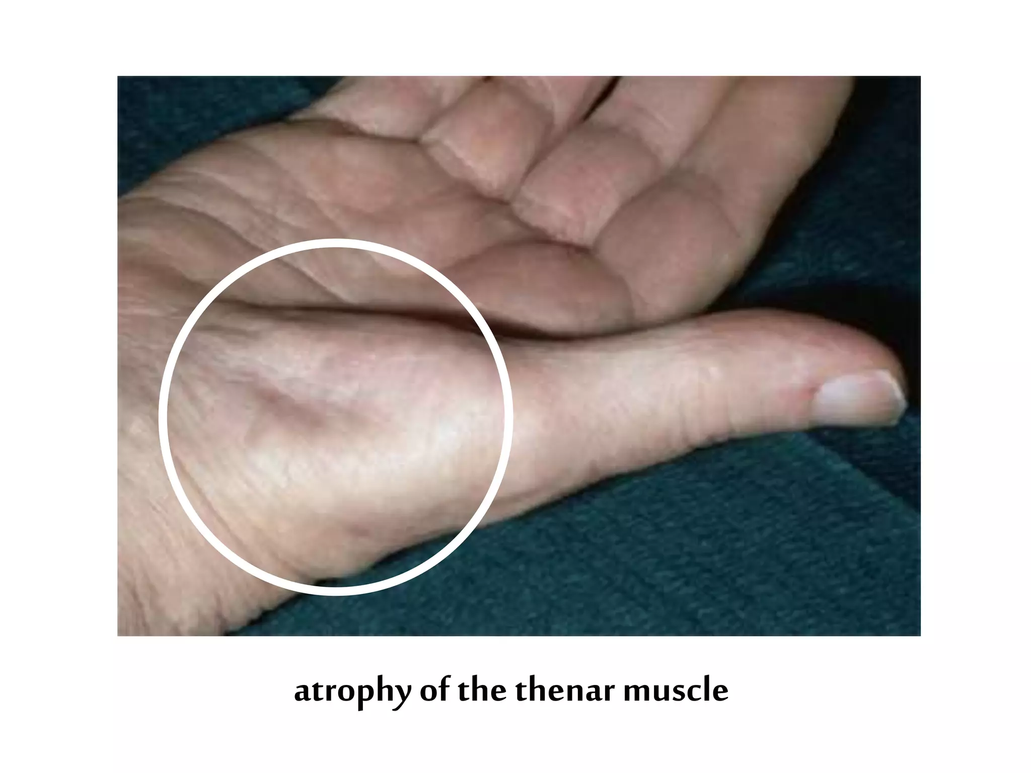 Carpal tunnel syndrome | PPTX