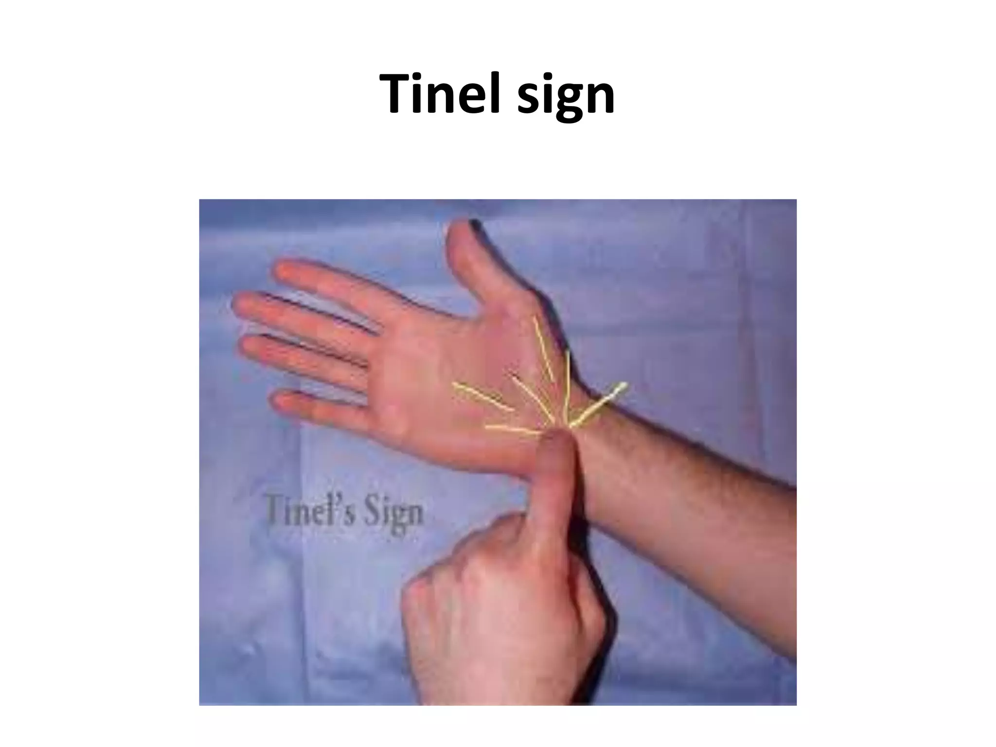 Carpal tunnel syndrome | PPTX