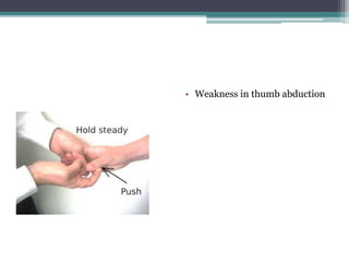 Carpal Tunnel Syndrome | PPTX