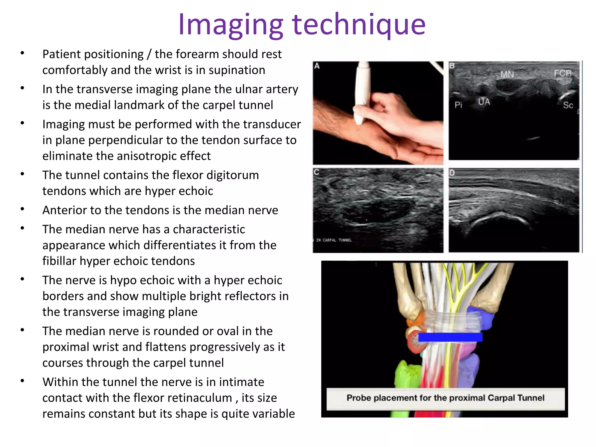 Carpal tunnel syndrome ( cts )us criteria | PPT