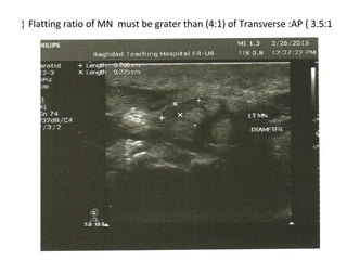 Carpal tunnel syndrome ( cts )us criteria | PPT
