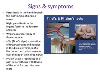 Carpal tunnel syndrome ( cts )us criteria | PPT