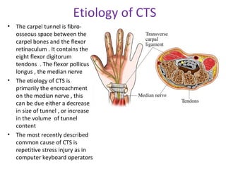 Carpal tunnel syndrome ( cts )us criteria | PPT