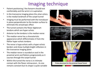 Carpal tunnel syndrome ( cts )us criteria | PPT