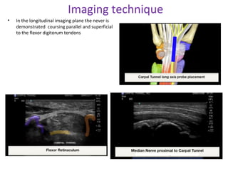 Carpal tunnel syndrome ( cts )us criteria | PPT