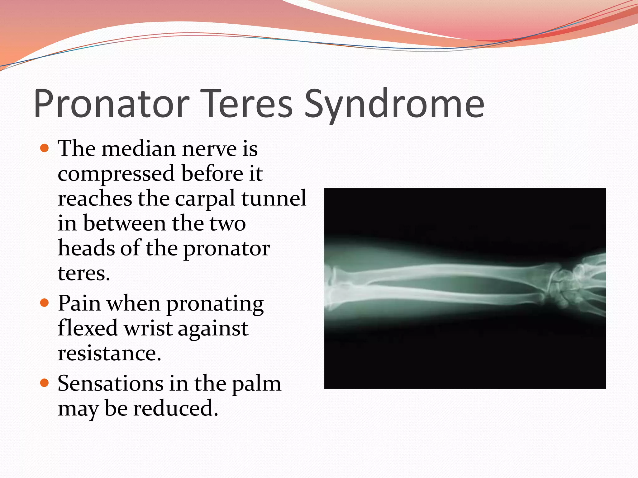 Carpal Tunnel Syndrome | PPTX