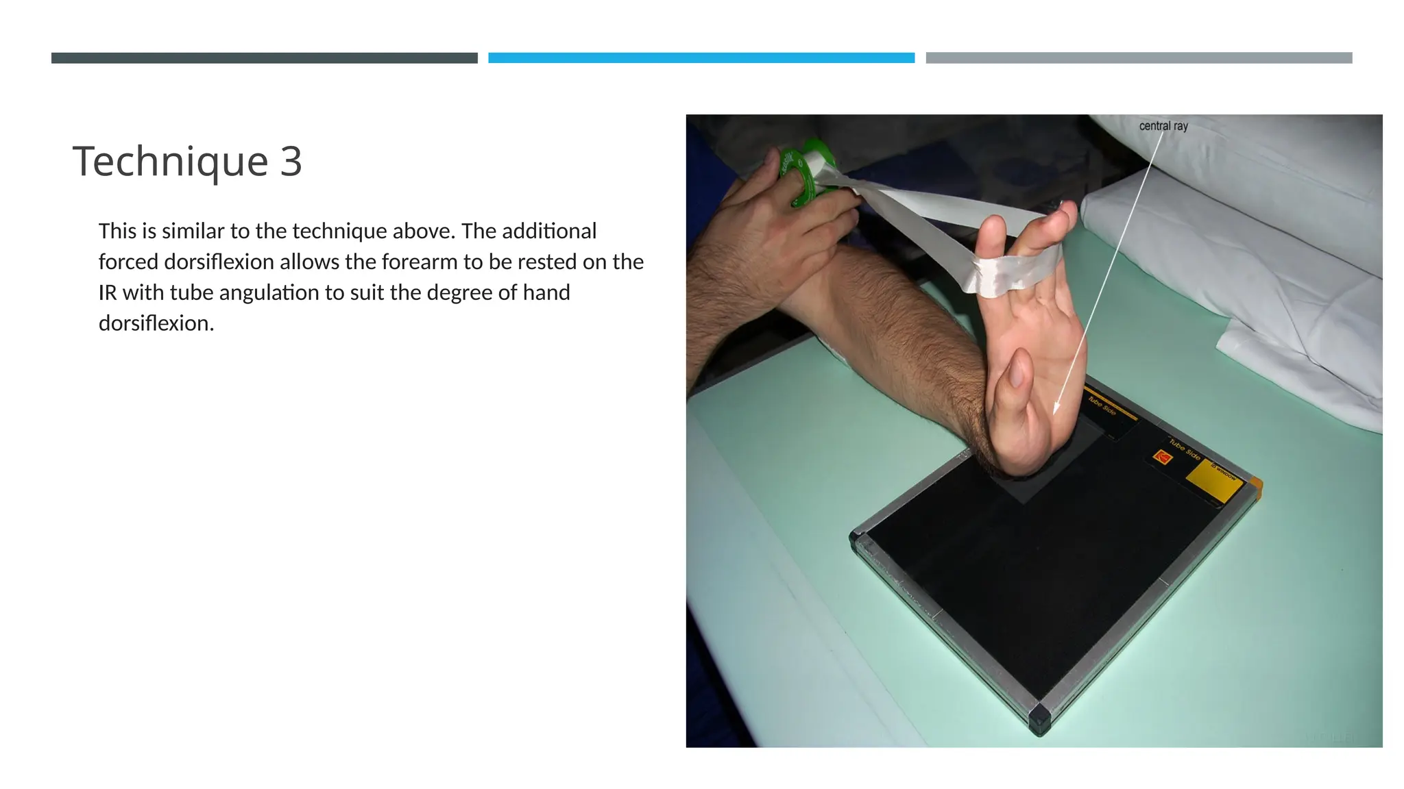 CARPAL TUNNEL VIEW and it's different techniques to perform | PPTX