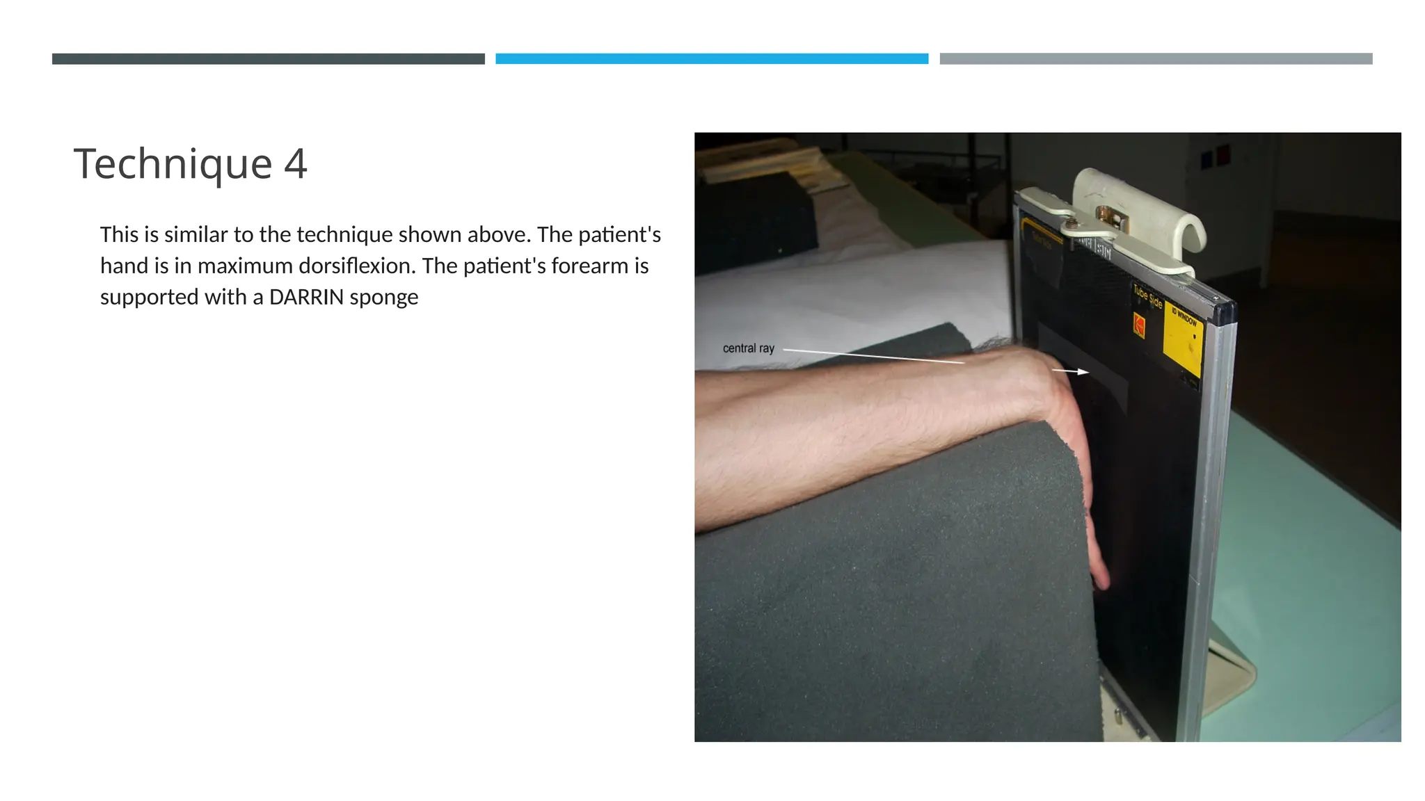 CARPAL TUNNEL VIEW and it's different techniques to perform | PPTX