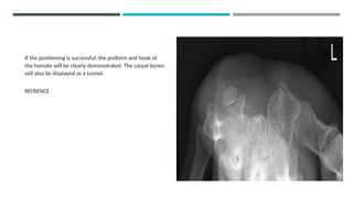 CARPAL TUNNEL VIEW and it's different techniques to perform | PPTX