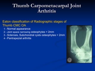 Carpometacarpal ( C) | PPT
