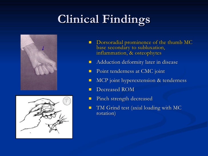 Carpometacarpal ( C)