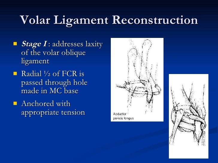 Carpometacarpal ( C)