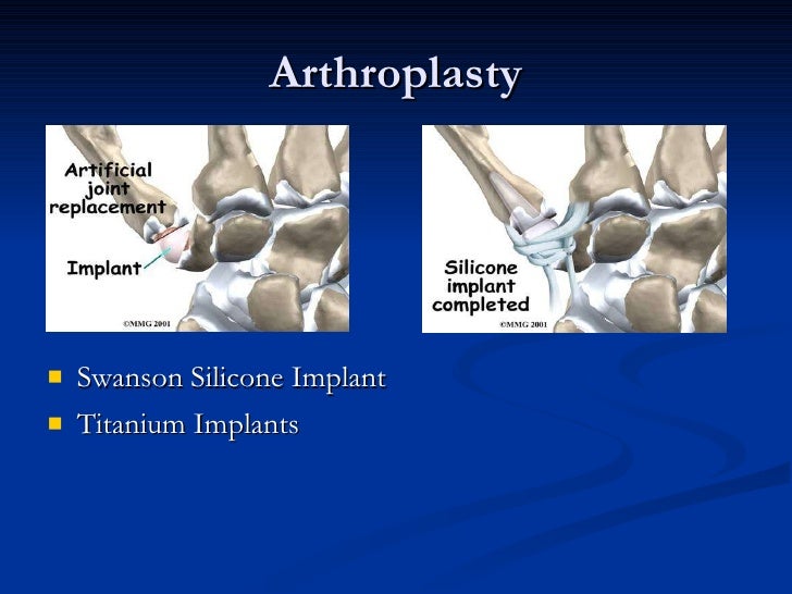 Carpometacarpal ( C)