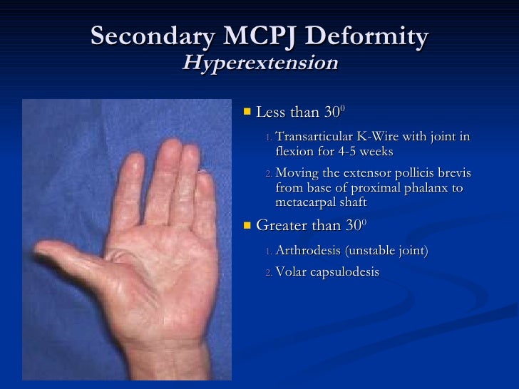 Carpometacarpal ( C)