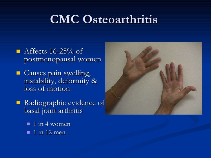 Carpometacarpal ( C)