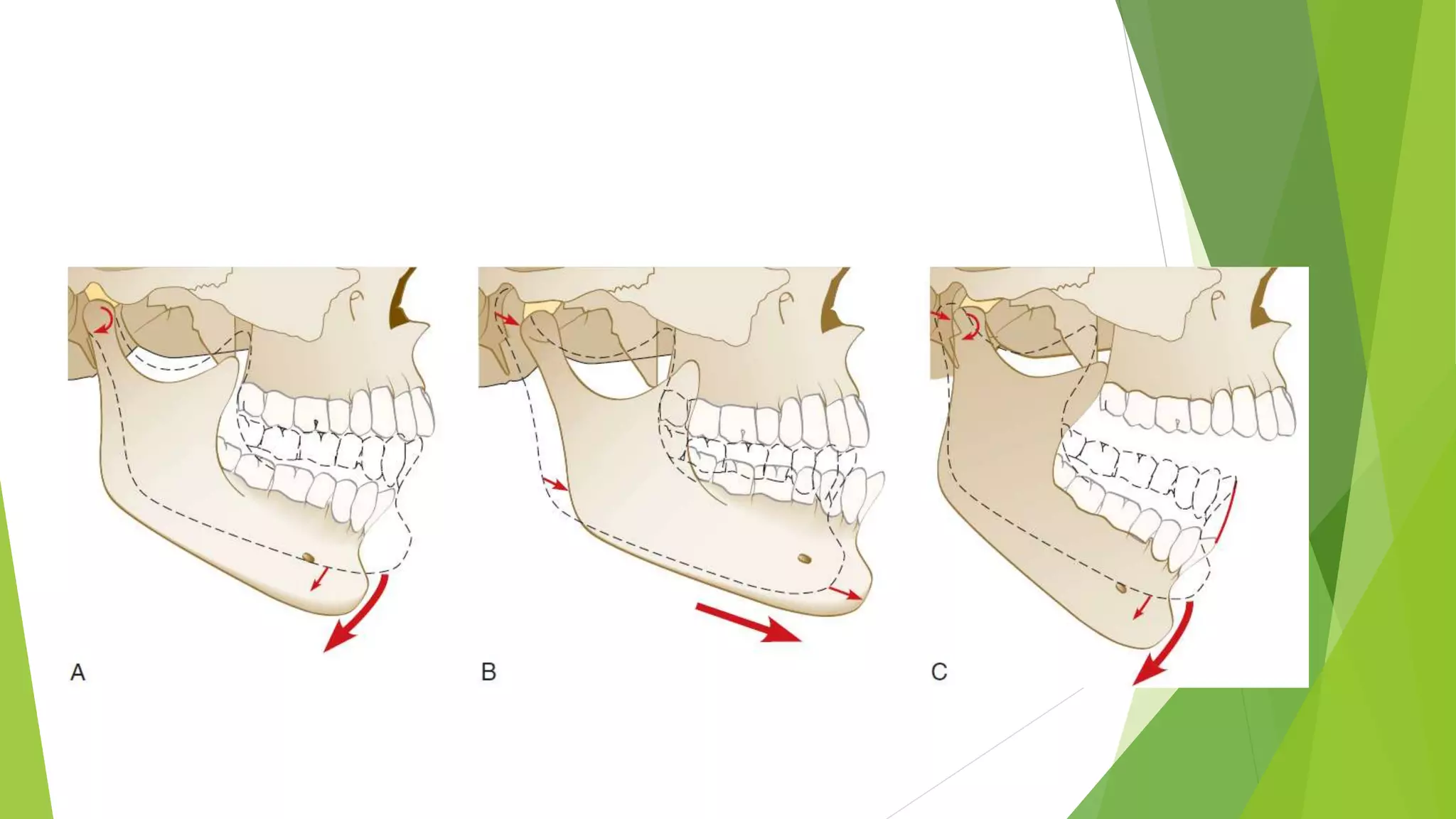 masticatory system disorders that influence periodontium | PPTX