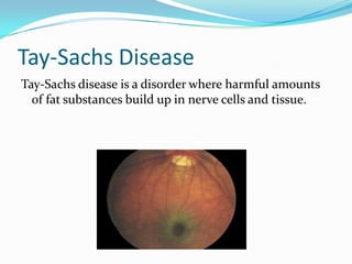 Tay Sachs Disease | PPTX
