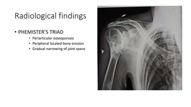 Carries sicca | PPTX | Bone and Joint Conditions | Diseases and Conditions