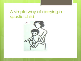 Carrying and positioning of Children with Cerebral Palsy | PPTX