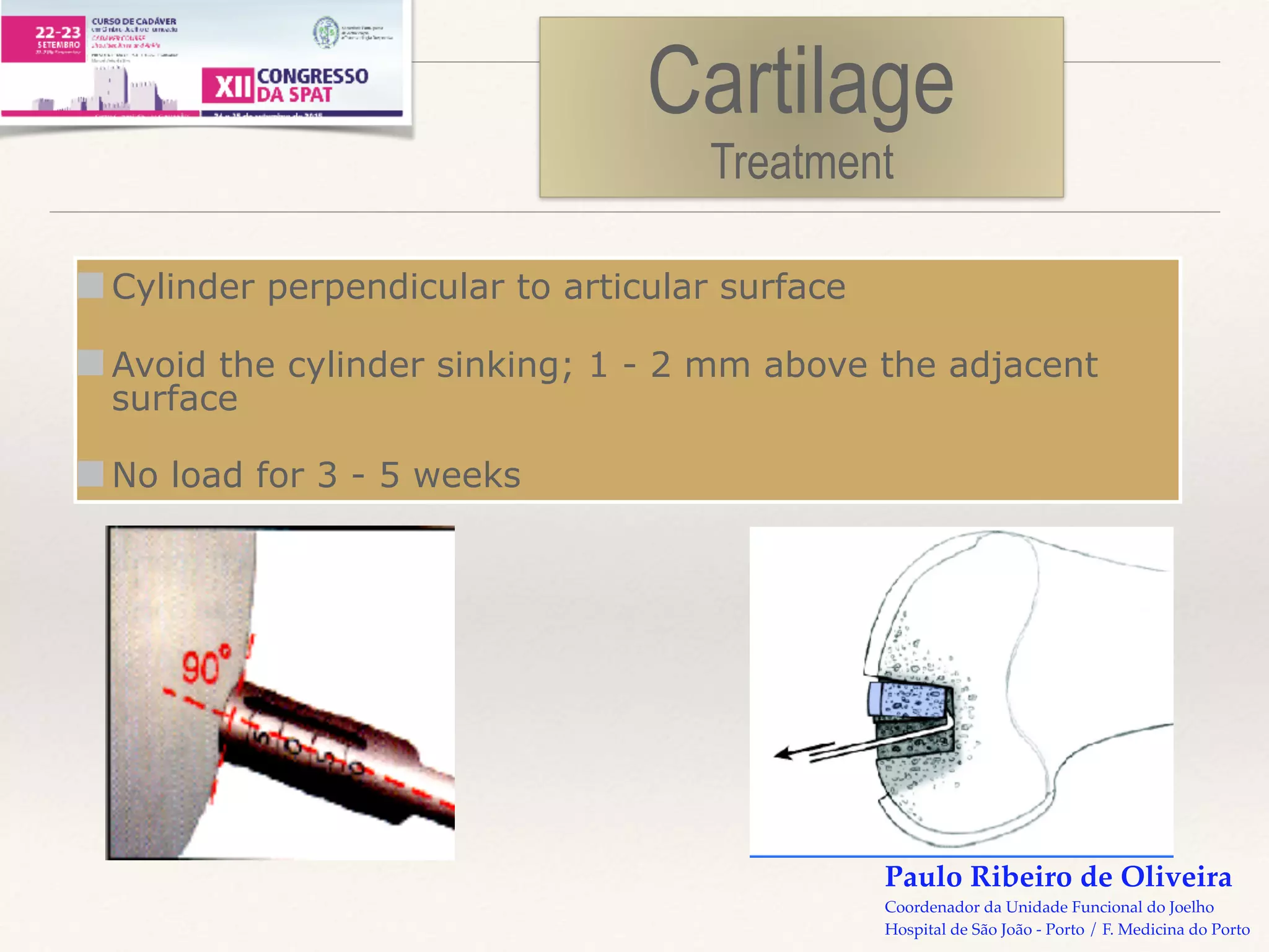 Cartilage Lesion - How i Do it | PDF