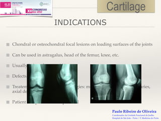 Cartilage Lesion - How i Do it | PDF