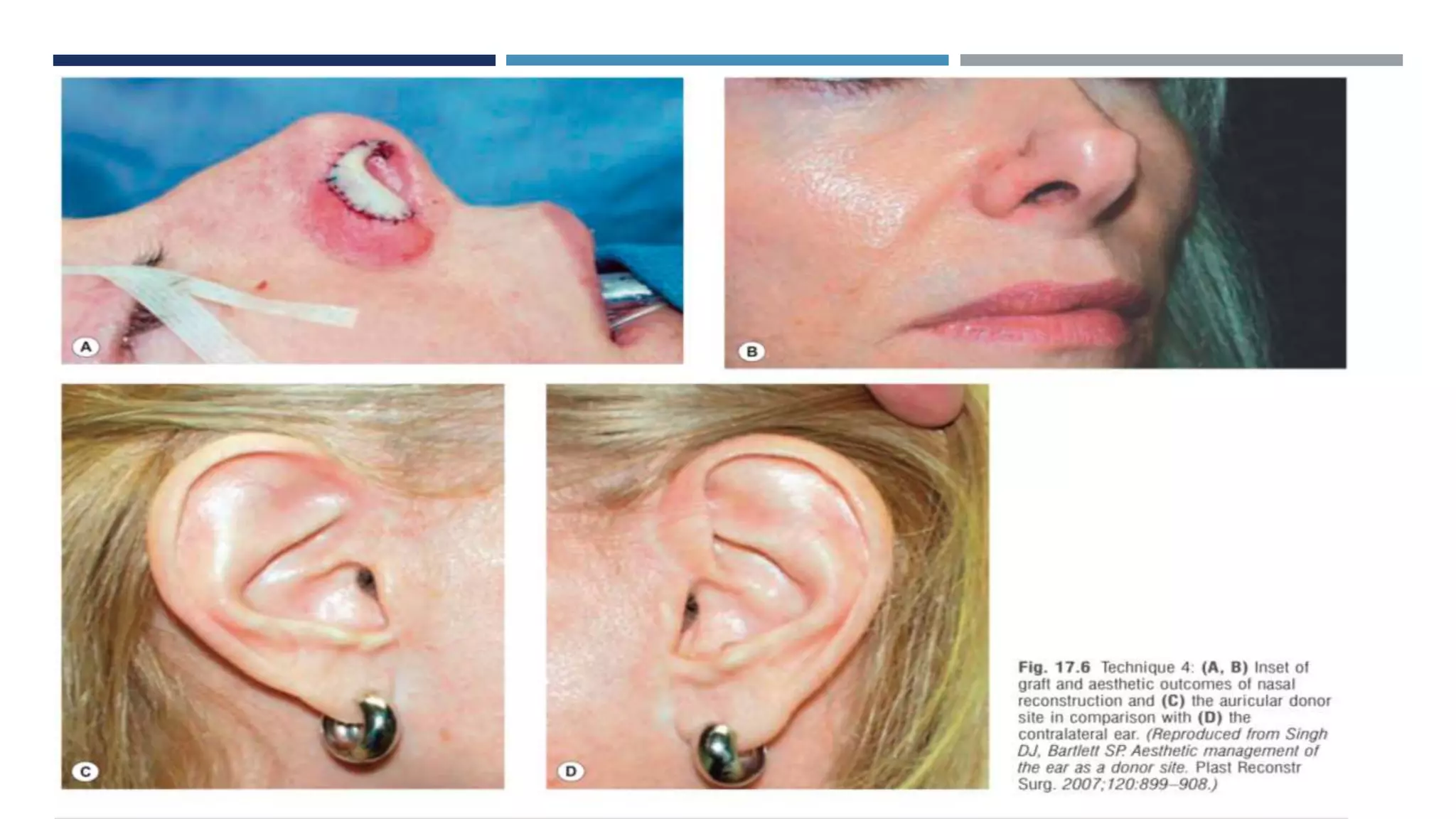 cartilage graft and healing.pptx