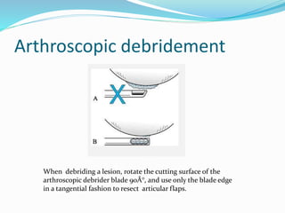 Cartilage injuries | PPTX