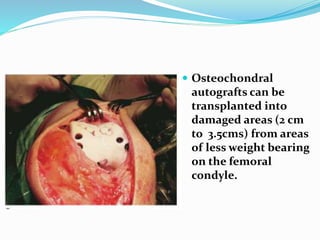 Cartilage injuries | PPTX