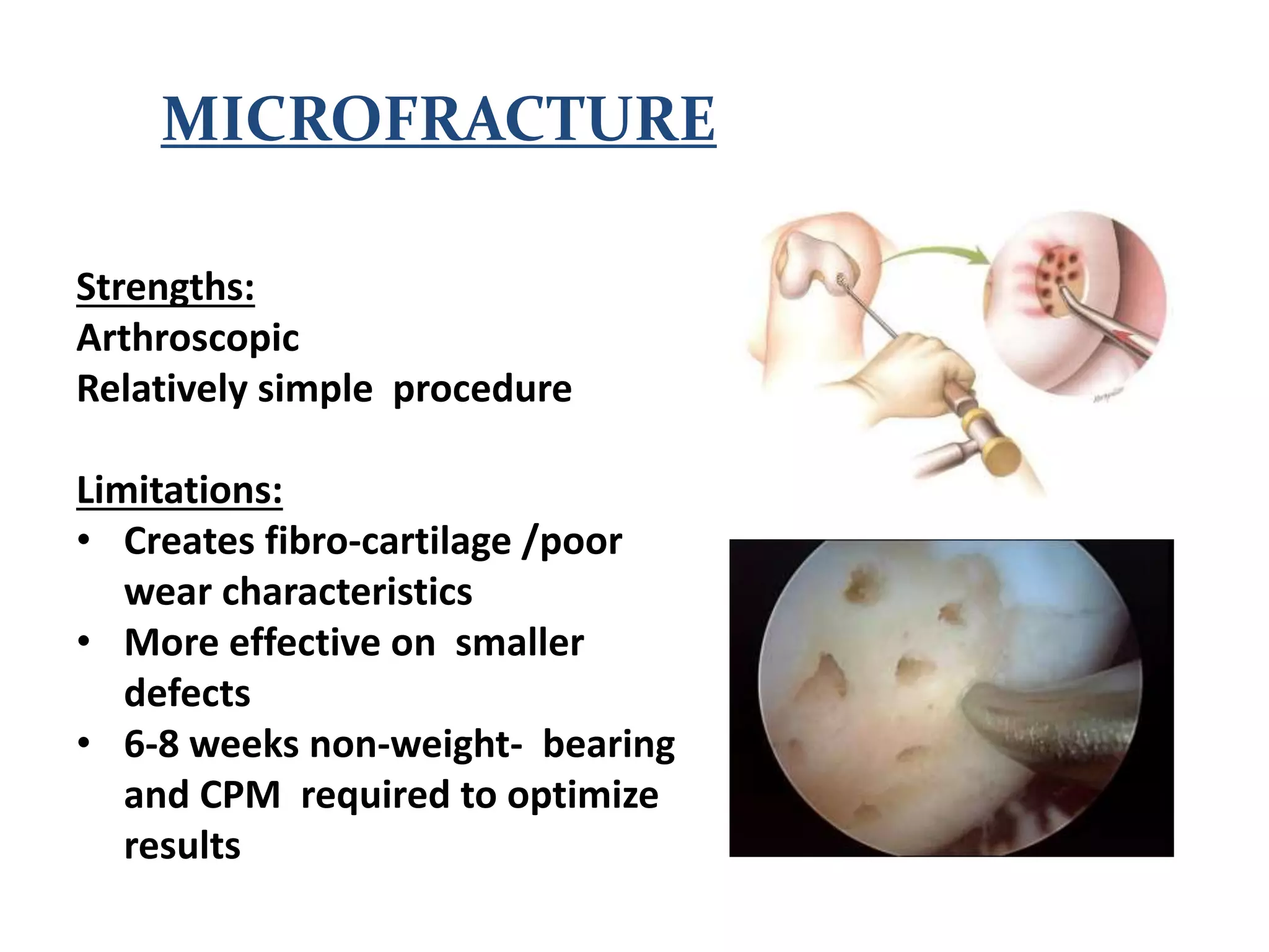 Management of Cartilage injuries | PPTX