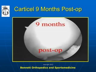 Cartilage Regeneration Sarasota | PDF | Physical Therapy | Wellness