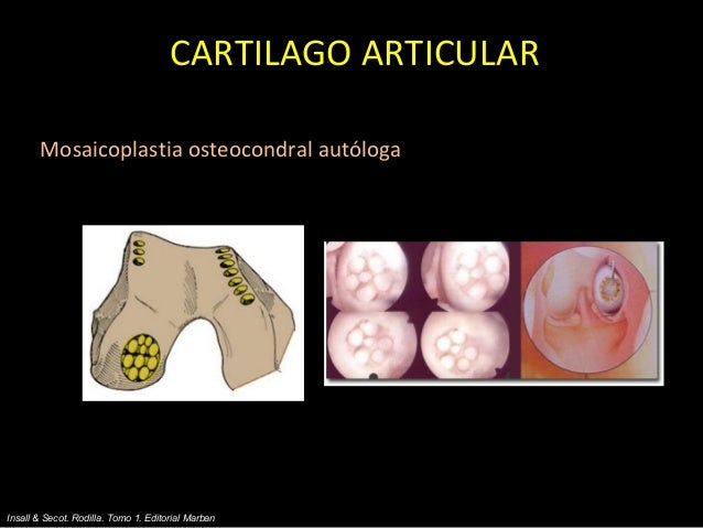 El Cartílago articular en la rodilla