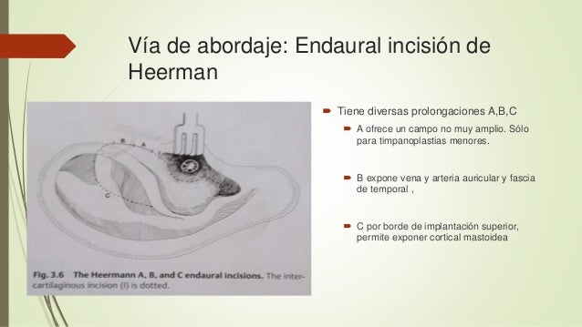 Cartílago en la miringoplastia