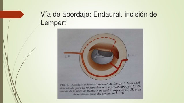 Cartílago en la miringoplastia