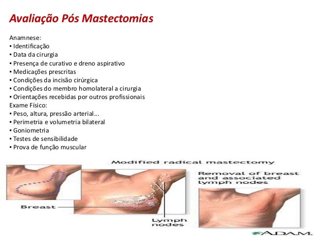 Cartilha mastectomia