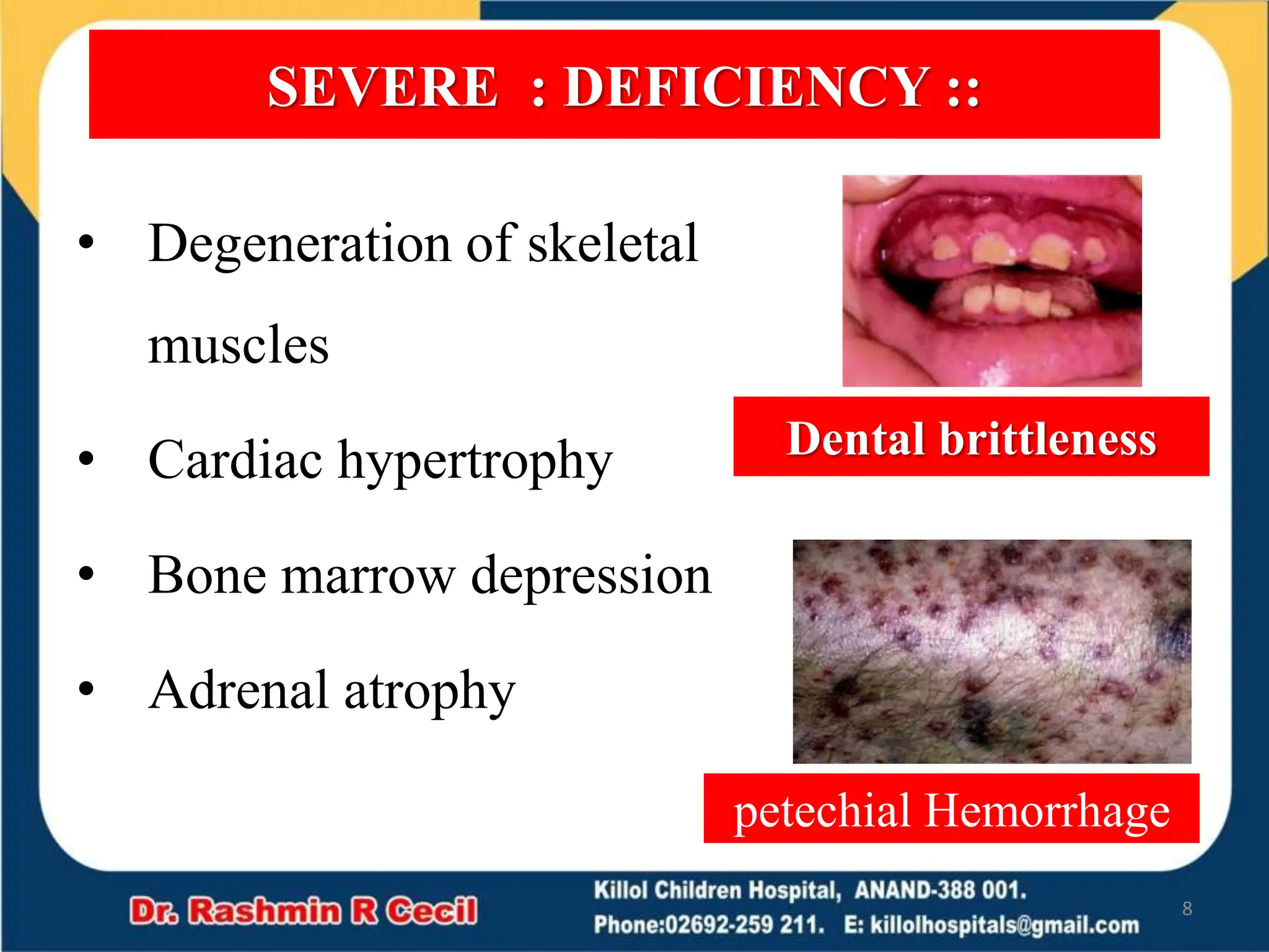Deficiency of Vitamin-C _Ascorbic acid_Pediatrics | PPT