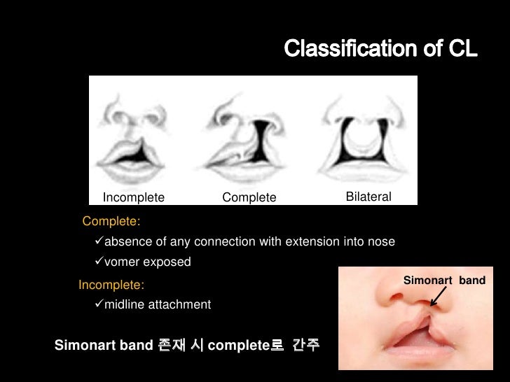 Case review(cleft lip)