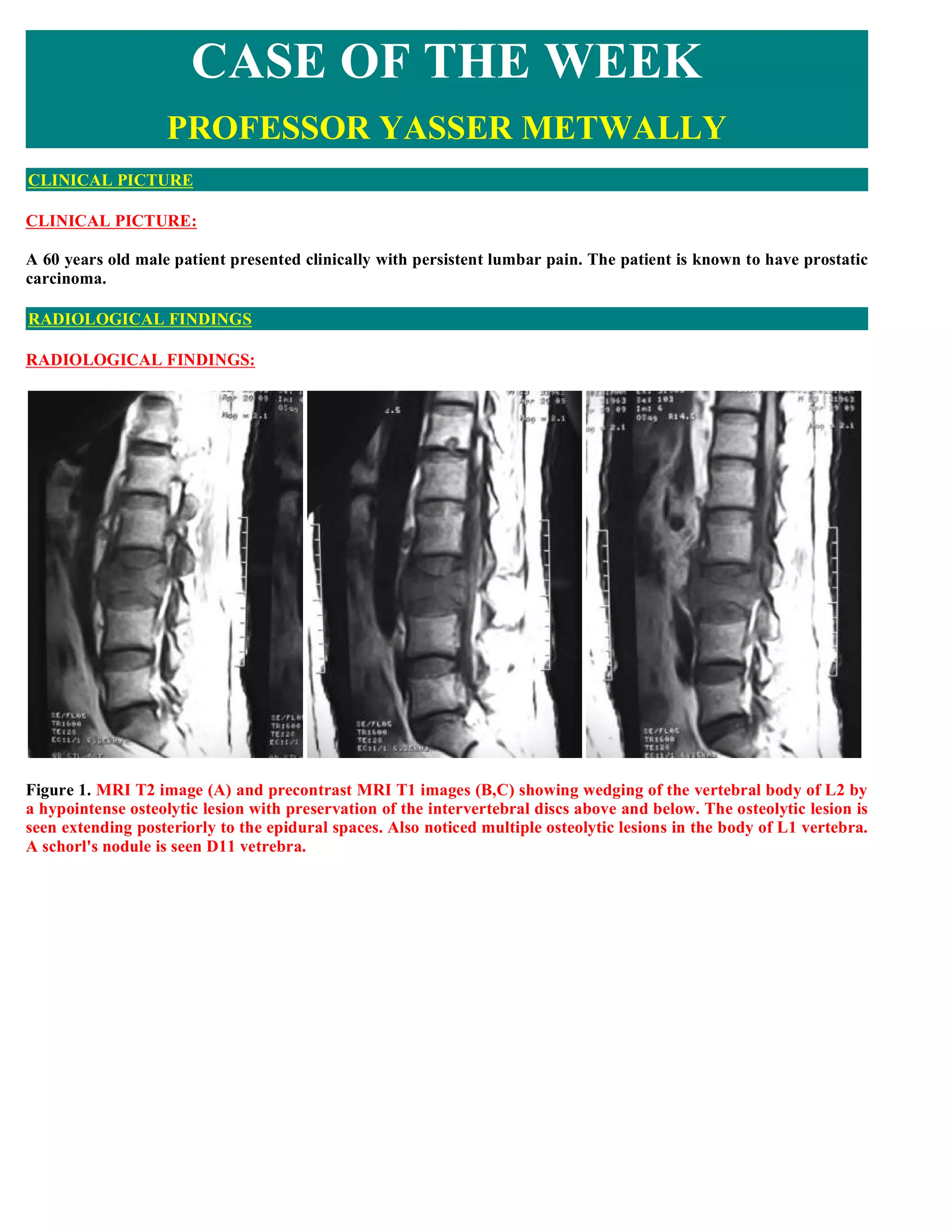 Case record...Spinal metastasis | PDF