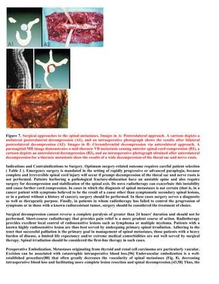 Case record...Spinal metastasis | PDF