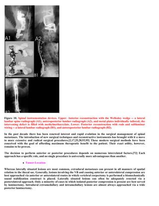 Case record...Spinal metastasis | PDF