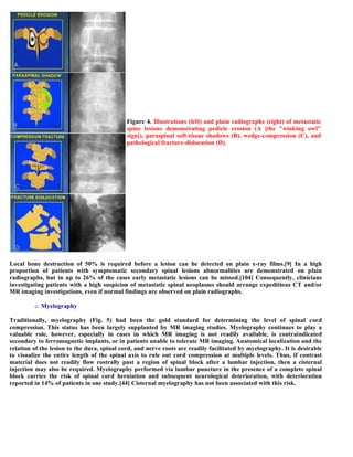 Case record...Spinal metastasis | PDF