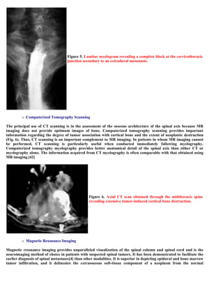Case record...Spinal metastasis | PDF